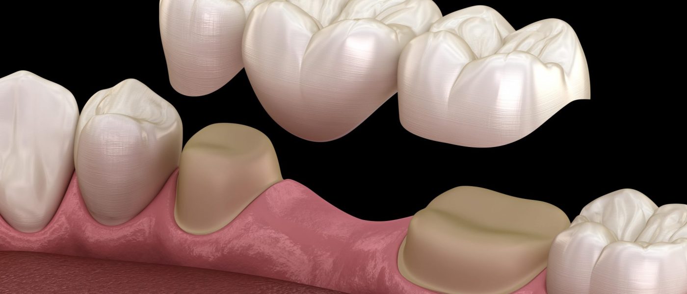 Bridge dentaire en Algérie à Blida, tout ce que vous devez savoir.